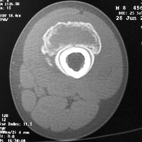 Traumatic Periostitis Ossificans of Femur (MRI) | Medicalchemy Orthopaedics