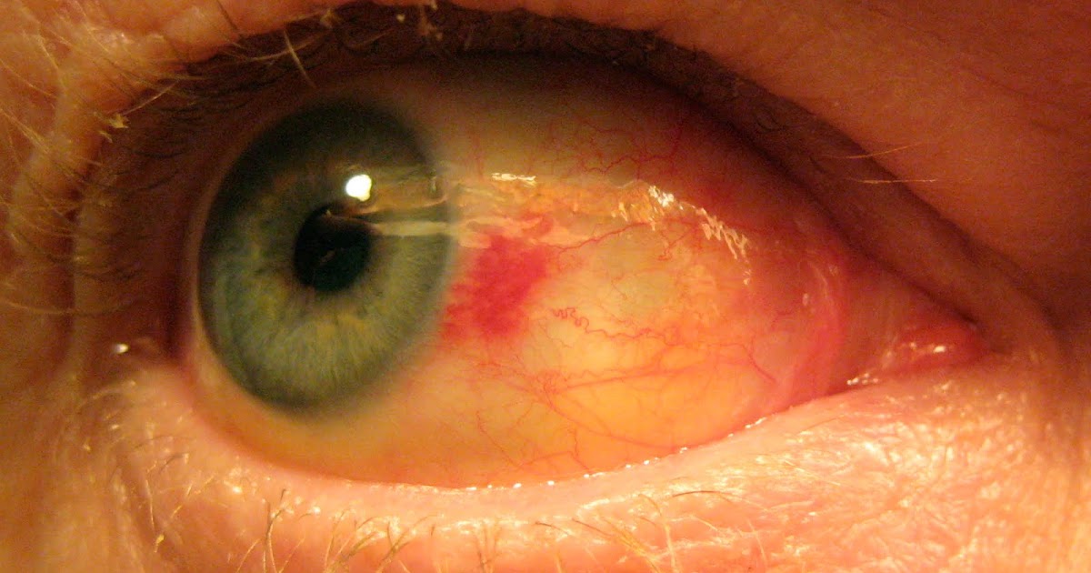 Random Walks: Subconjunctival Hemorrhage