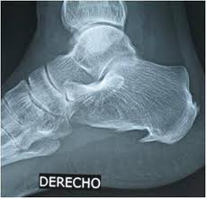 Osteófito-Esporões do calcanhar