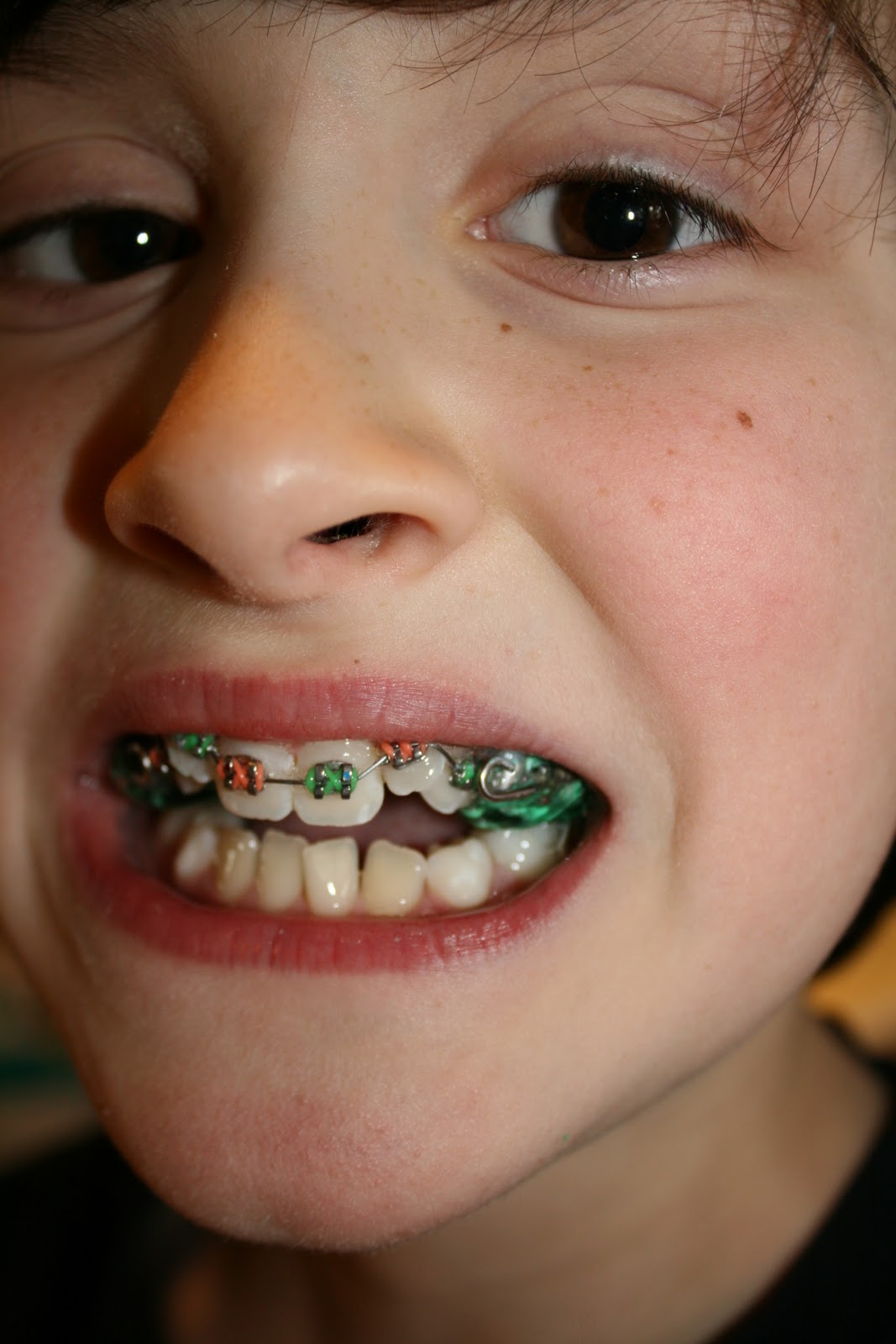 A Day in the Life: Brace Face (Phase One)