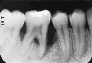ORAL Odontologia: Periodontite Juvenil