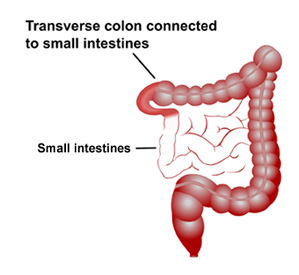 Channeling Jackie-O: Next Steps: Right Hemicolectomy and Tumor Board at RWJ