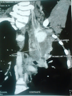 Pseudoaneurisma disecante con trombo mural infectado (causa de FOD ...