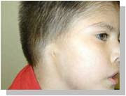 Alteraciones Audio-Vestibular: Anotia