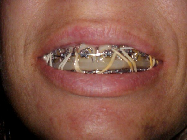 Cheryl's Upper & Lower Jaw Surgery