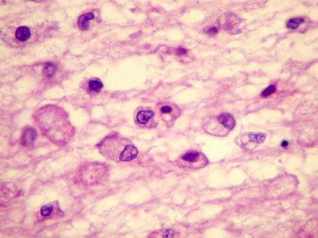 Patologia Geral: Necrose por liquefação