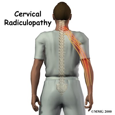 Jay's Physio: Radiculopathy