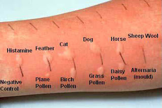 Living With Allergic Rhinitis: Skin Prick Test For Allergic Rhinitis