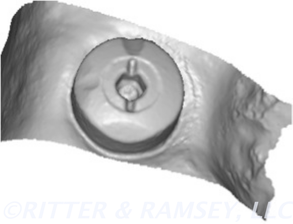Ritter & Ramsey - General and Cosmetic Dentistry: 3i-3M Digital Implant ...