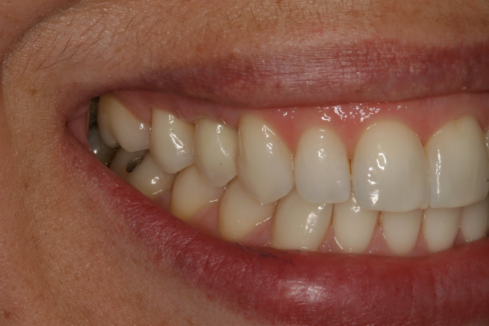 Ritter & Ramsey - General and Cosmetic Dentistry: 3i-3M Digital Implant ...
