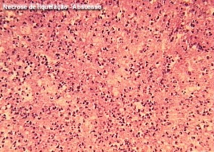 PaToLoGiA na FiSiO: Necrose de Liquefação