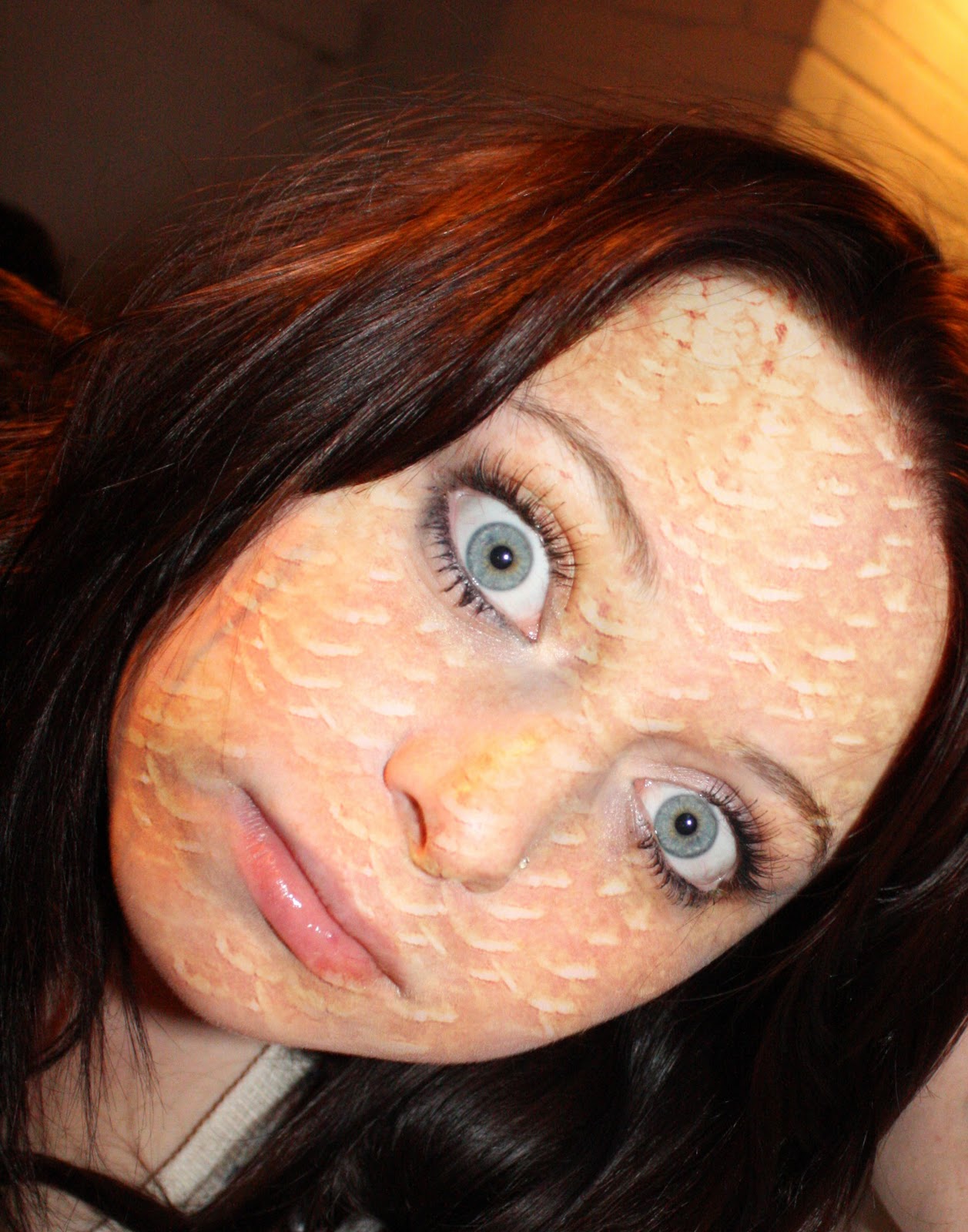 Ichthyosis Vulgaris Face