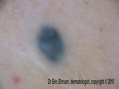 dermoscopy: Blue lesion on a leg