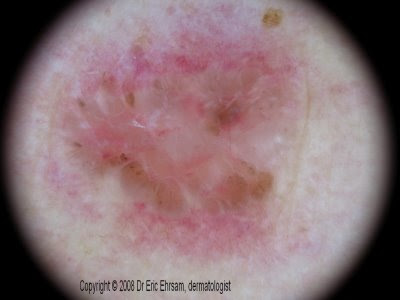 dermoscopy: Leaf-like structures