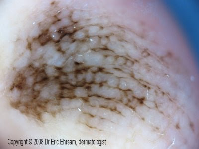 dermoscopy: Acral melanocytic nevus