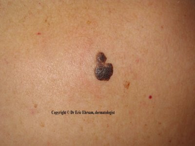 dermoscopy: Seborrheic keratosis