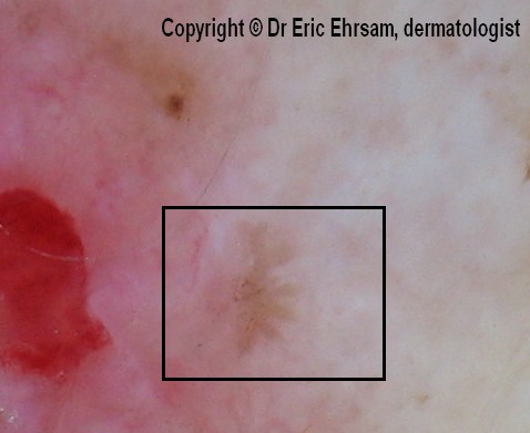 dermoscopy: Basal cell carcinomas