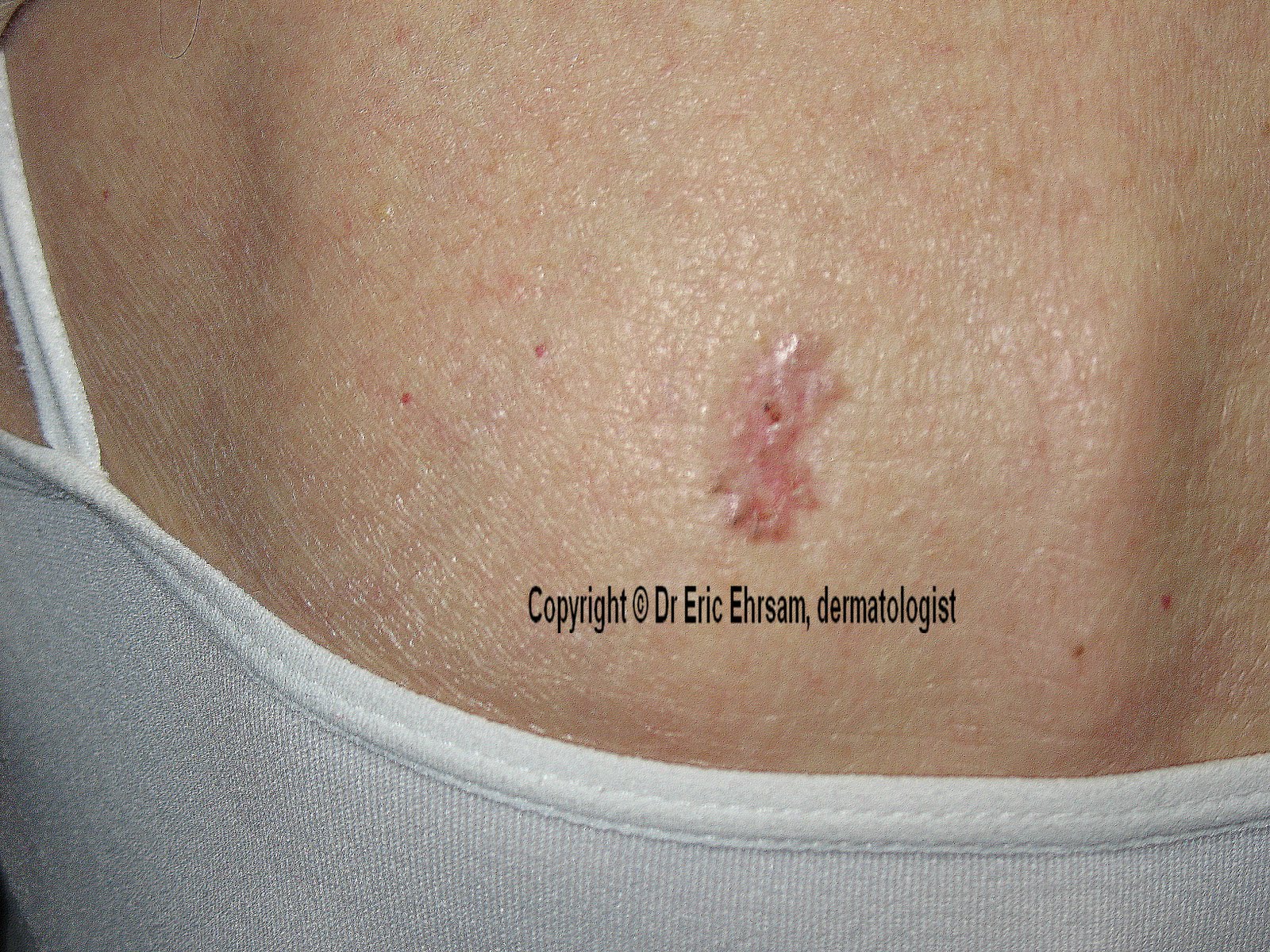 dermoscopy: Basal cell carcinomas