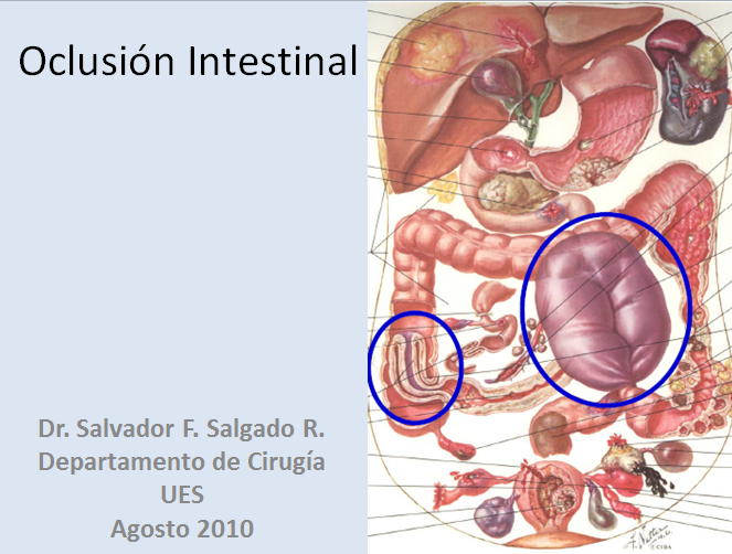 Presentación de Oclusión Intestinal | Médicos de Año Social UES 2012