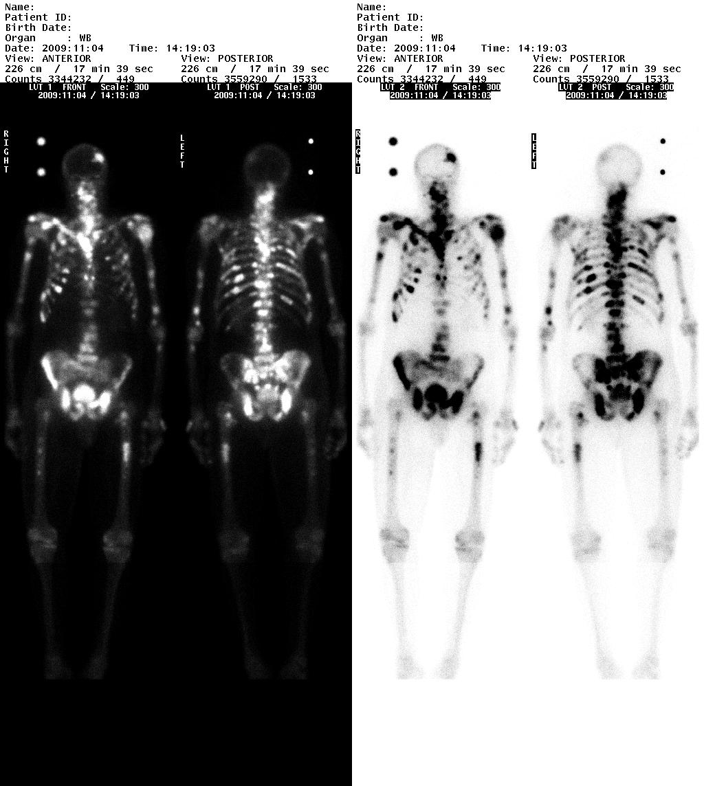 Thanatopsis - Meditation Upon Death...: Metastatic TCC bladder to bone