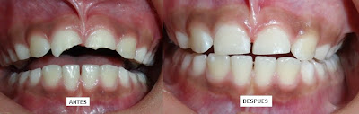 Fracturas Dentales