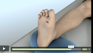 maya | modeling | animation: Proposal: Below Knee Amputation - Surgical ...