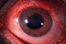 Iritis: A Case study