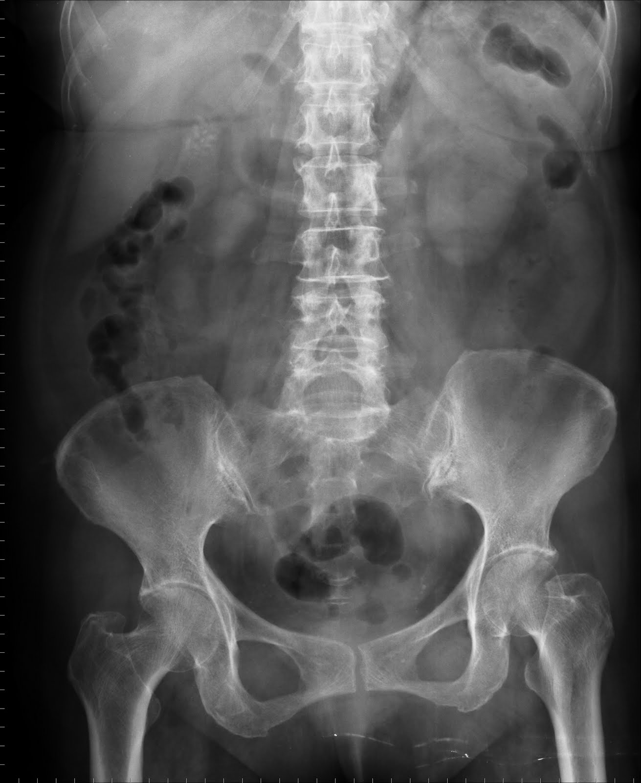Cafe Radiologi: Teknik Pemeriksaan Kontras "Colon In Loop"