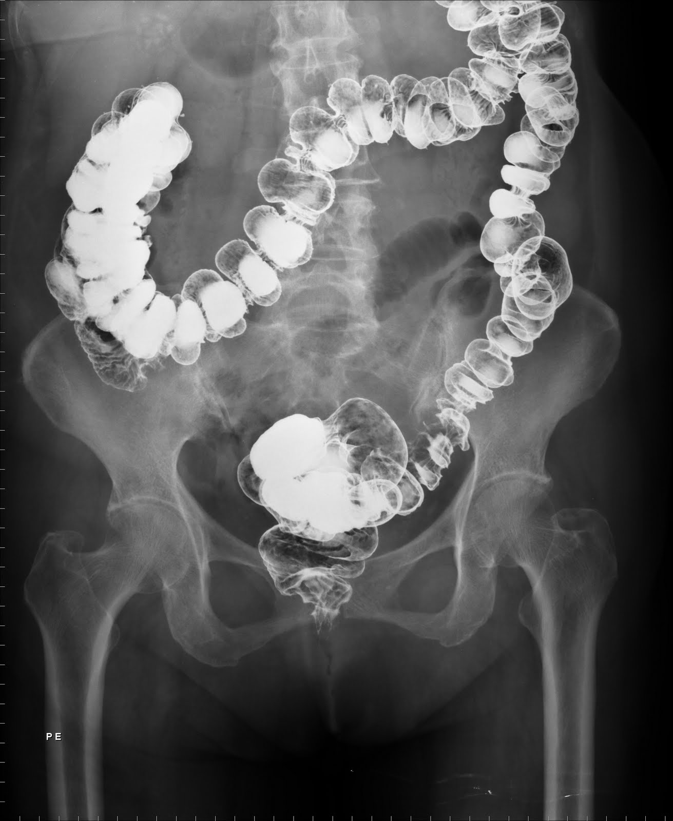 Cafe Radiologi: Teknik Pemeriksaan Kontras "Colon In Loop"