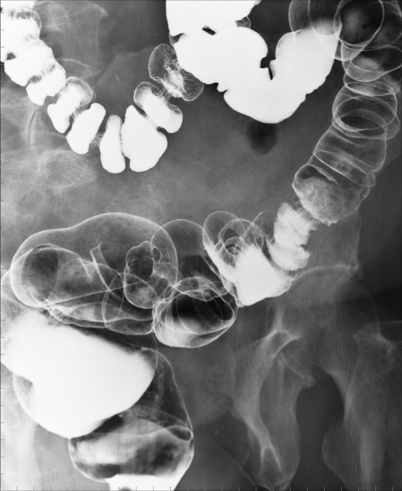Cafe Radiologi: Teknik Pemeriksaan Kontras "Colon In Loop"