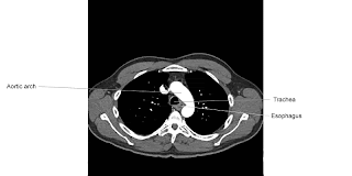 Cafe Radiologi: Anatomi dari gambaran CT Scan Thorax