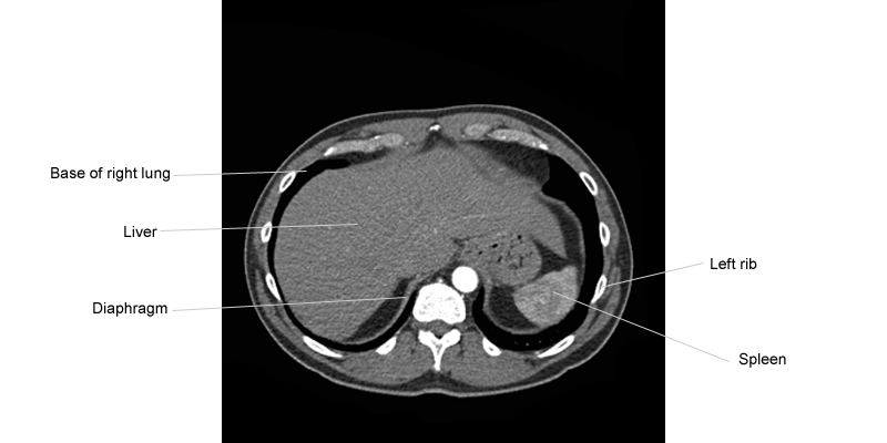 Cafe Radiologi: Anatomi dari gambaran CT Scan Thorax