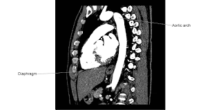 Cafe Radiologi: Anatomi dari gambaran CT Scan Thorax