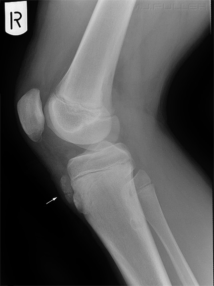 Khusnun Indah: TEKNIK PEMERIKSAAN GENU (KNEE JOINT)