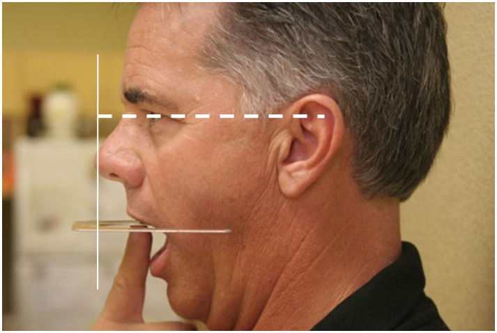 Occlusion Connections Blog: What Angle is the Occlusal Plane Relative ...