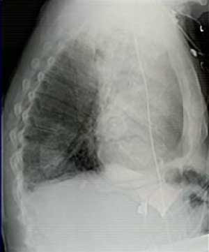 Nothing To Do With Arbroath: Man has pea plant removed from lung