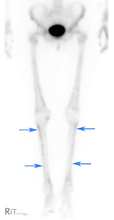 RiT radiology: Hypertrophic Pulmonary Osteoarthropathy (HPOA)