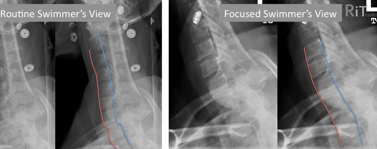 RiT radiology: Swimmer's View Lateral Cervical Spine Radiograph