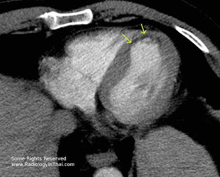 RiT radiology: Left Ventricular Mass in Patient with Old Myocardial ...