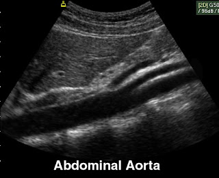 RiT radiology: Normal Abdominal Aorta