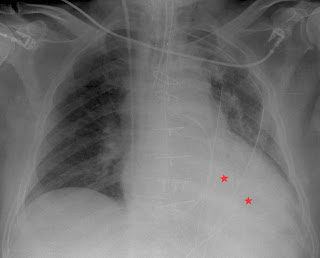 Left Hemothorax X Ray