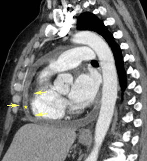 RiT radiology: Pericardial Effusion on Lateral Chest Radiograph