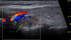 What Do The Colors Mean In A Thyroid Cancer Ultrasound Images With Color