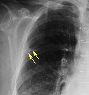 RiT radiology: Chest Wall Fat Mimicking Tumor