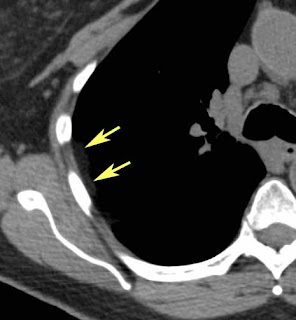 RiT radiology: Chest Wall Fat Mimicking Tumor