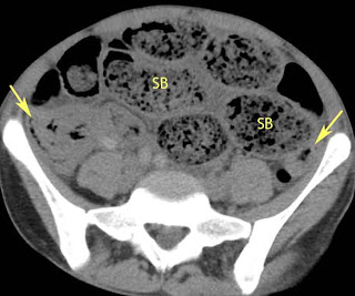 RiT radiology: Distal Intestinal Obstruction Syndrome (DIOS)