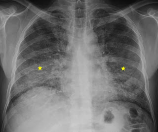 RiT radiology: Pulmonary Alveolar Proteinosis (PAP)