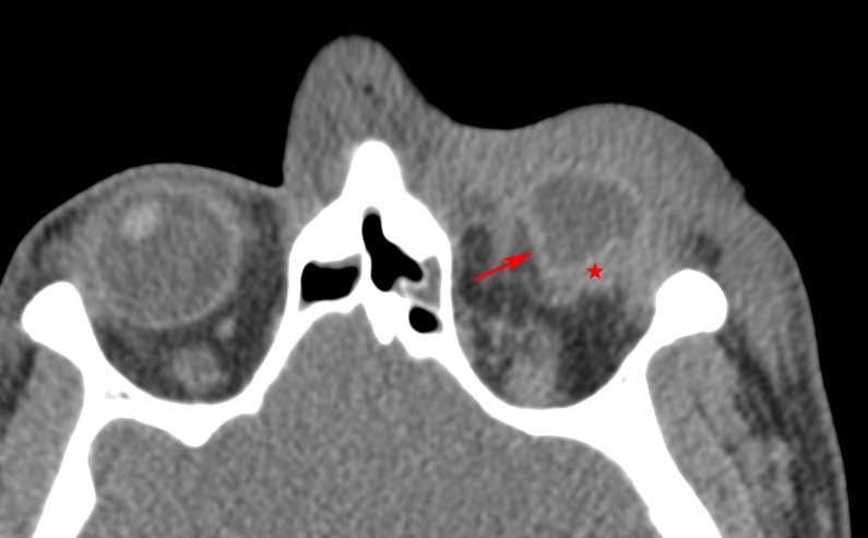 RiT radiology: CT Findings of Open-Globe Injuries