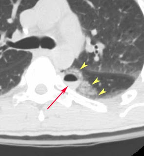 RiT radiology: Pulmonary Laceration