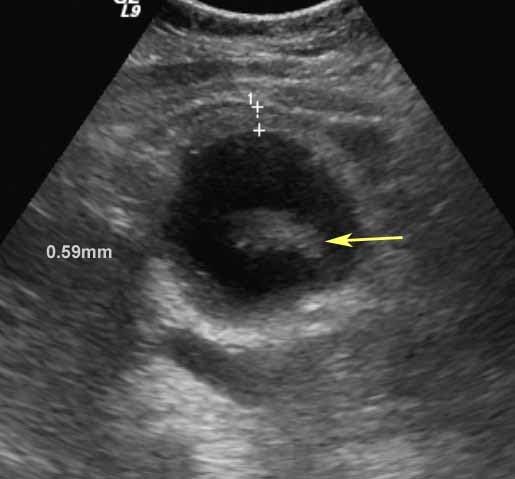 RiT radiology: Thickened Gallbladder Wall